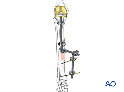 Temporary external fixator for Fracture distal to the tibial component ...