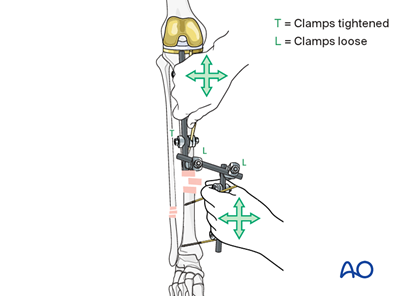 Temporary external fixator for Fracture distal to the tibial component ...