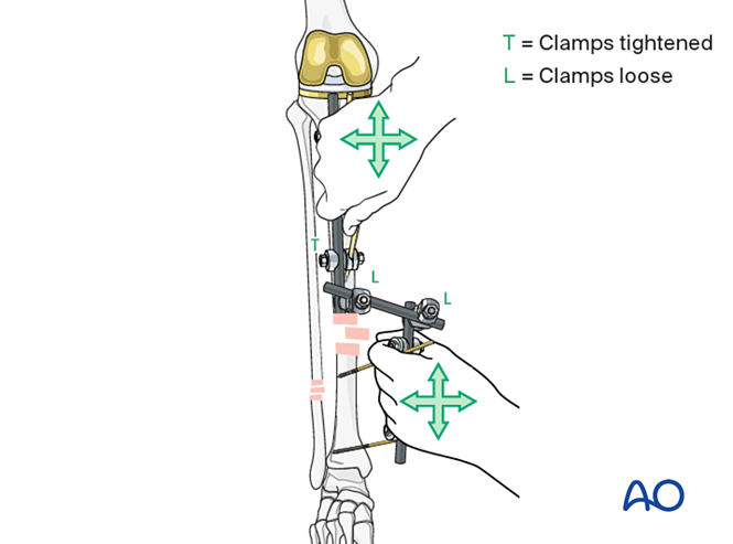 Temporary external fixator for Fracture distal to the tibial component ...