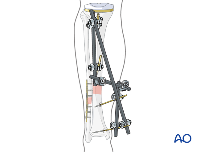 Temporary external fixator for Fracture distal to the tibial component ...