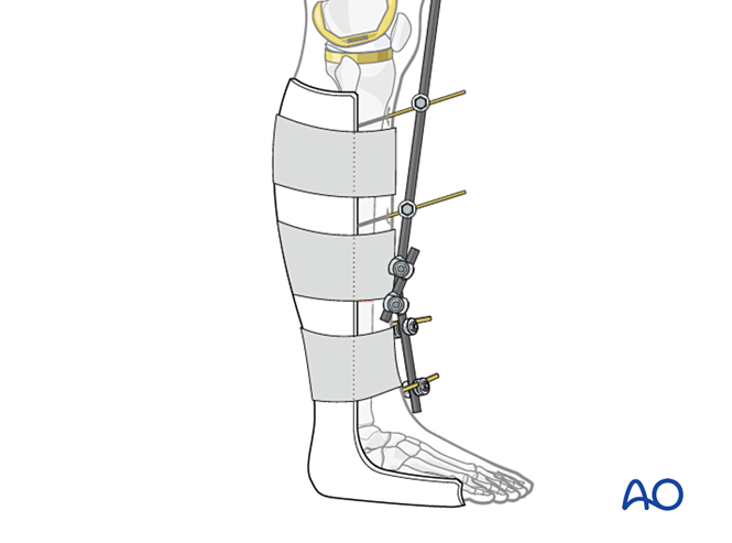 Temporary external fixator for Fracture distal to the tibial component ...