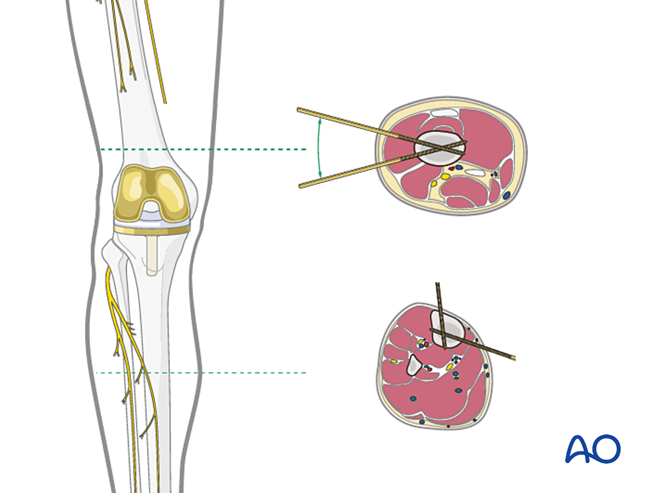Temporary external fixator for Nondisplaced tibial plateau or tubercle ...