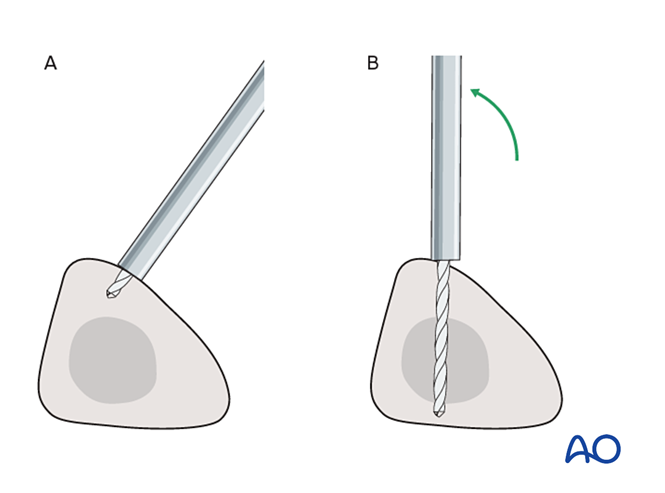Temporary external fixator for Nondisplaced tibial plateau or tubercle ...