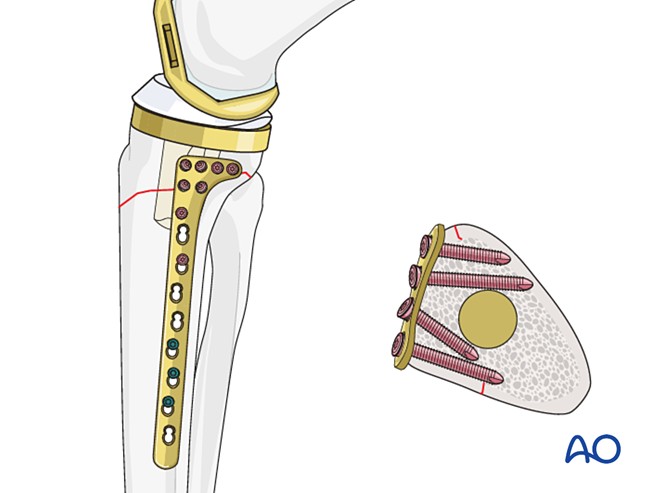 Compression plate for Fracture around a stable tibial component with ...