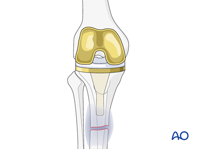 Compression plate for Fracture distal to the tibial component and ...