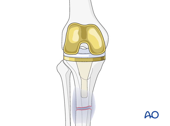 Compression plate for Fracture distal to the tibial component and ...