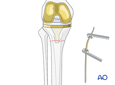 Compression plate for Fracture around a stable tibial component with ...