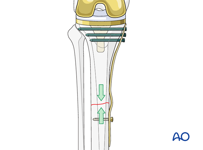Compression plate for Fracture distal to the tibial component and ...