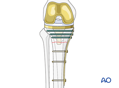 Compression plate for Fracture around a stable tibial component with ...