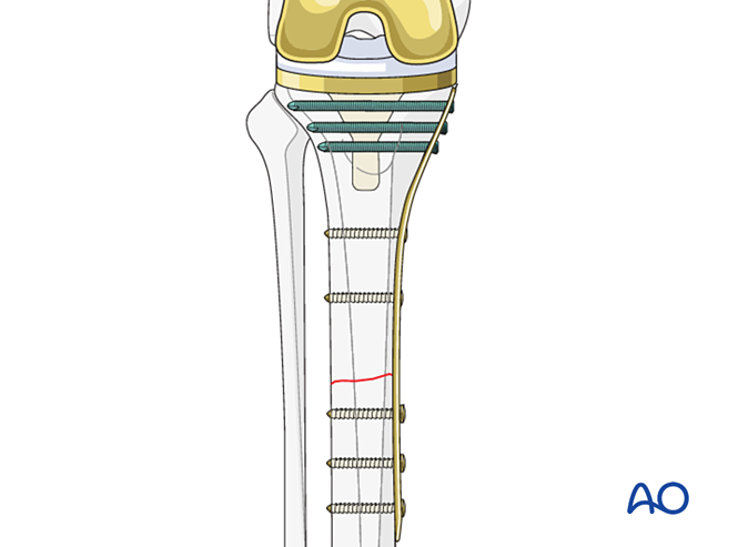 Compression plate for Fracture distal to the tibial component and ...
