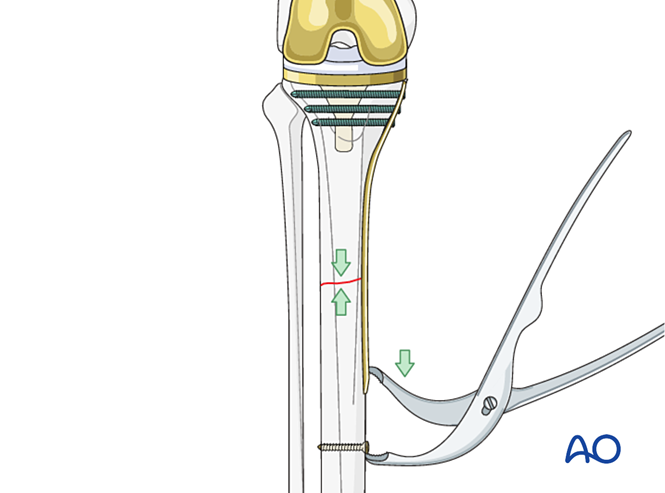 Compression plate for Fracture distal to the tibial component and ...