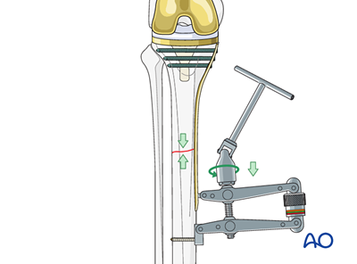 Compression plate for Fracture distal to the tibial component and ...