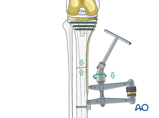 Compression plate for Fracture distal to the tibial component and ...