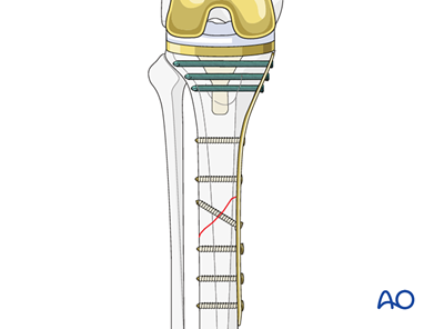 Compression plate for Fracture distal to the tibial component and ...