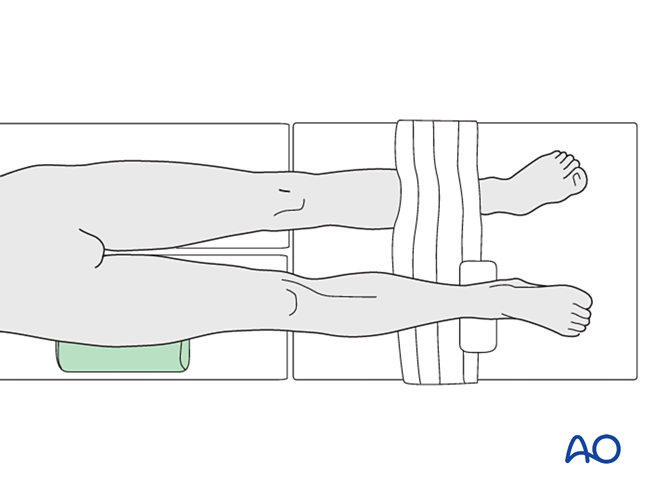 Lag screw with or without neutralization plate for Nondisplaced tibial ...