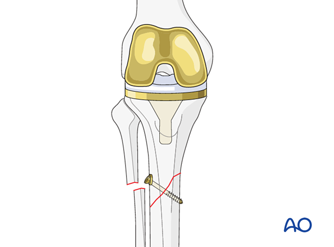Lag screw with or without neutralization plate for Fracture distal to ...