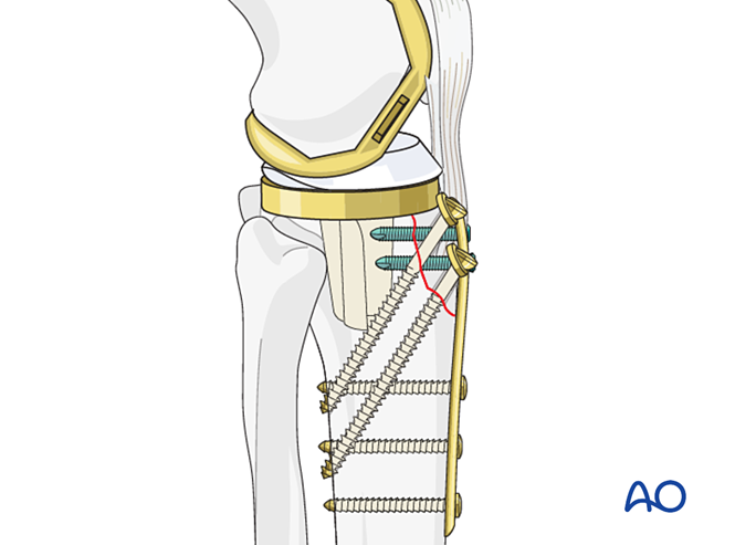 Lag screw with or without neutralization plate for Nondisplaced tibial ...