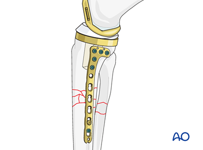 Bridge plate for Fracture distal to the tibial component and cement mantle