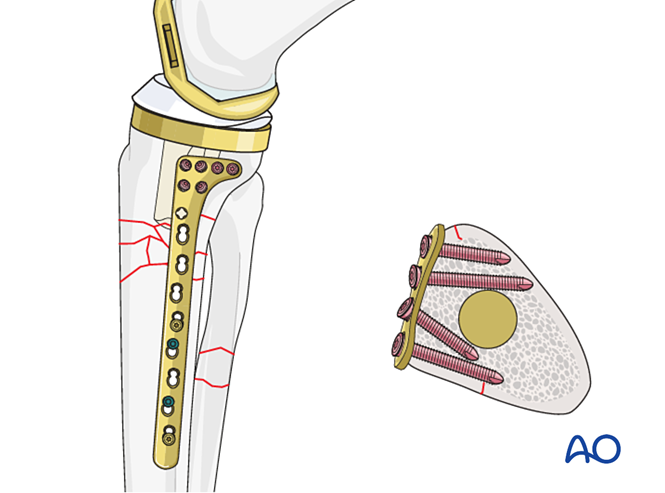 Bridge plate for Fracture around a stable tibial component with good ...