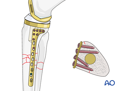 Bridge plate for Fracture distal to the tibial component and cement mantle