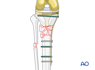 Bridge plate for Fracture around a stable tibial component with good ...