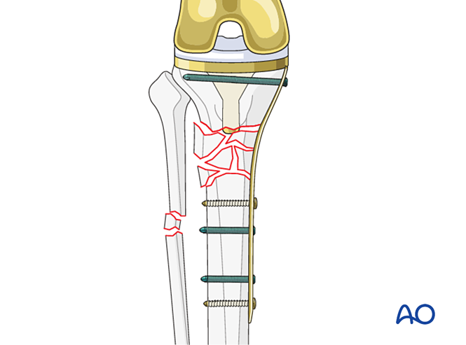 Bridge plate for Fracture around a stable tibial component with good ...