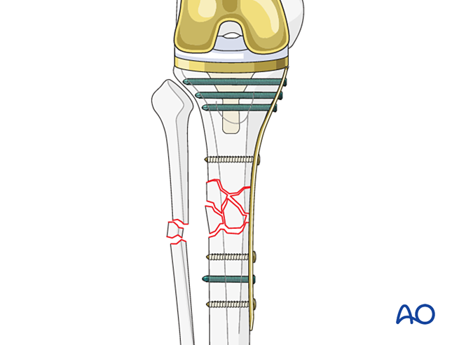 Bridge plate for Fracture distal to the tibial component and cement mantle