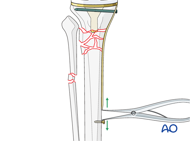 Bridge plate for Fracture around a stable tibial component with good ...