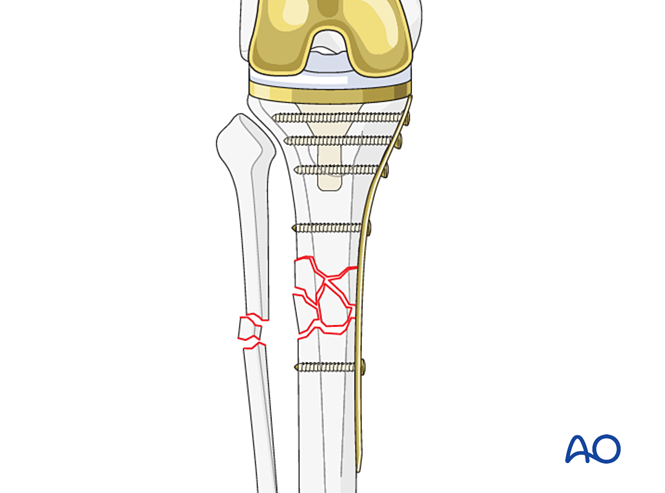 Bridge plate for Fracture distal to the tibial component and cement mantle