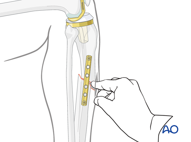 Antegrade nailing for Fracture distal to the tibial component and ...