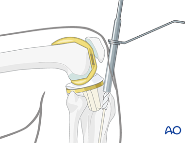 Antegrade nailing for Fracture distal to the tibial component and ...