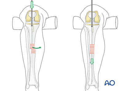 Antegrade nailing for Fracture distal to the tibial component and ...