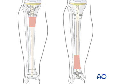 Antegrade nailing for Fracture distal to the tibial component and ...