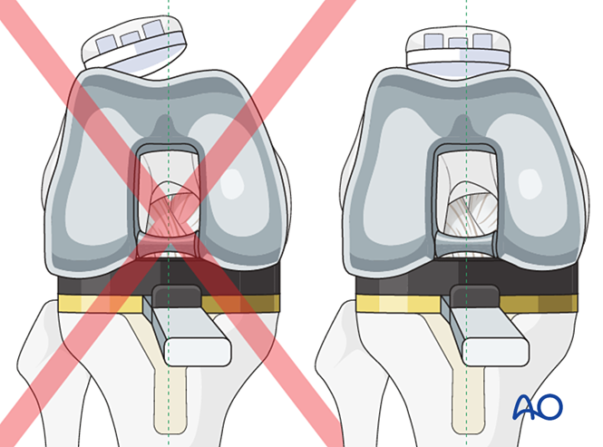 Complete femoral revision with varus/valgus CCK system for Fracture ...