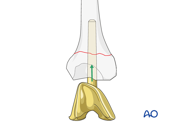 Complete femoral revision with varus/valgus CCK system for Fracture ...