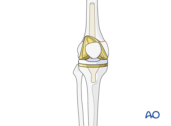 Complete femoral revision with varus/valgus CCK system for Fracture ...