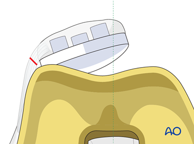 Complete tibial revision with varus/valgus CCK system for Fracture ...