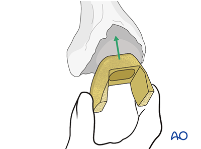 Complete femoral revision with hinged knee for Fracture around a loose ...