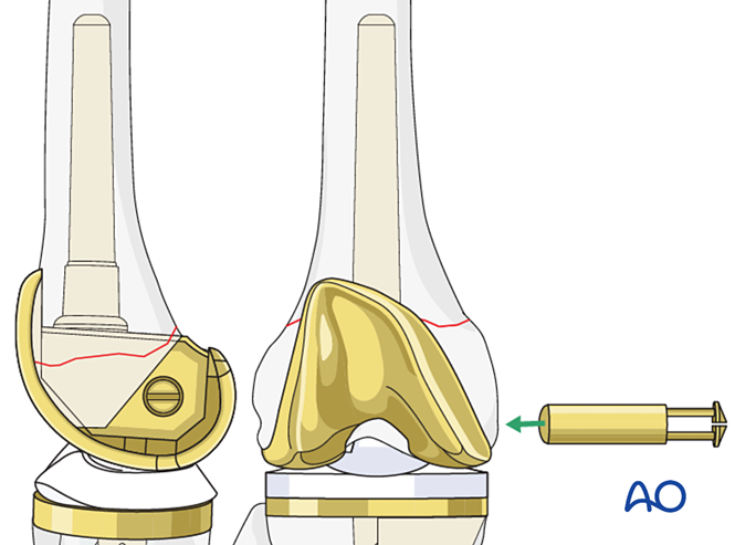 Complete femoral revision with hinged knee for Fracture around a loose ...