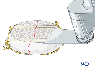 Patella component revision with or without ORIF for Fracture around ...