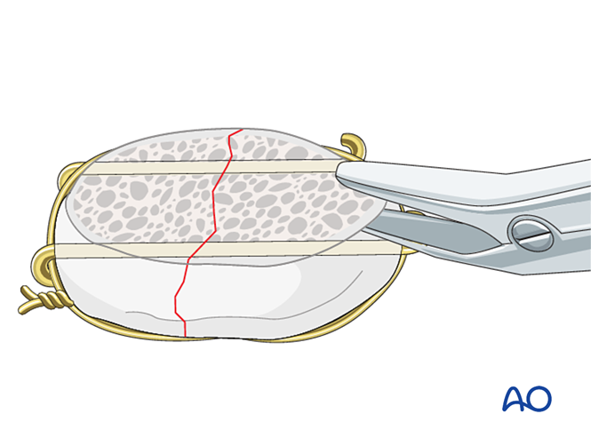 Patella component revision with or without ORIF for Fracture around ...