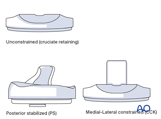 Complete tibial revision with varus/valgus CCK system for Fracture ...