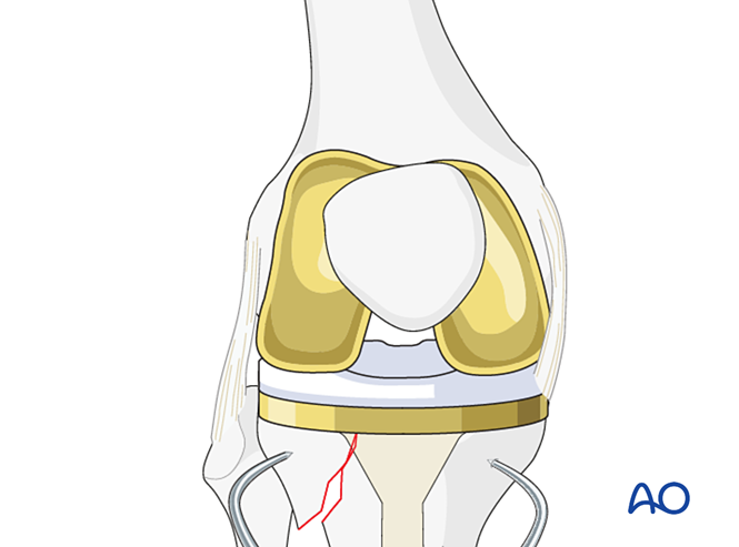 Complete tibial revision with varus/valgus CCK system for Fracture ...