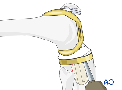 Complete tibial revision with varus/valgus CCK system for Fracture ...