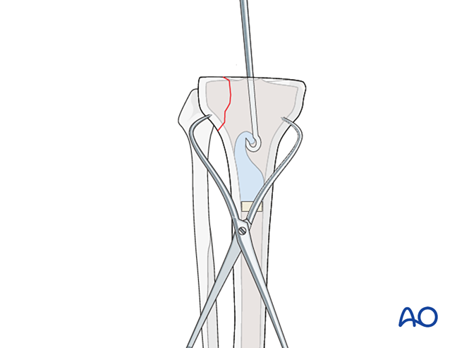 Complete tibial revision with varus/valgus CCK system for Fracture ...