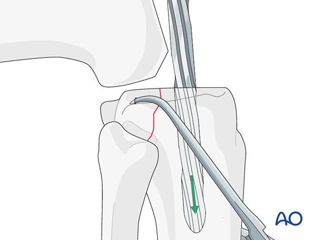 Complete tibial revision with varus/valgus CCK system for Fracture ...