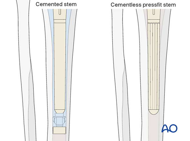 Complete tibial revision with varus/valgus CCK system for Fracture ...