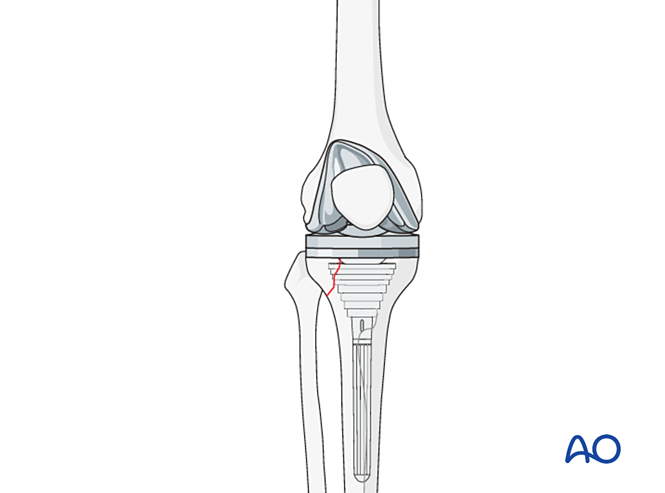 Complete tibial revision with varus/valgus CCK system for Fracture ...