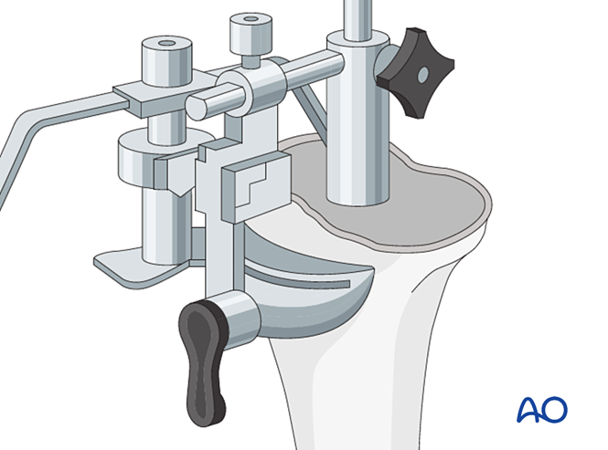 Complete tibial revision with varus/valgus CCK system for Fracture ...