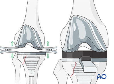 Complete tibial revision with varus/valgus CCK system for Fracture ...